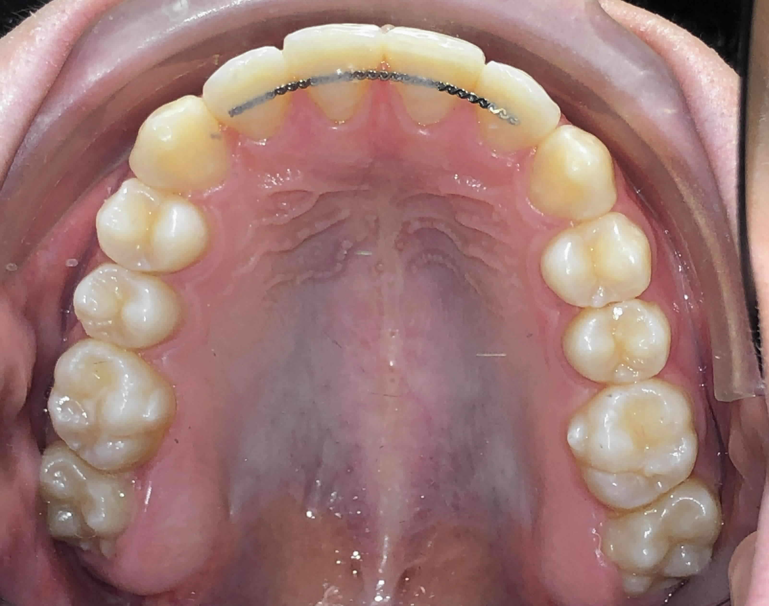 Appareils de contention pour enfant et adulte - Cabinet Challe & Co