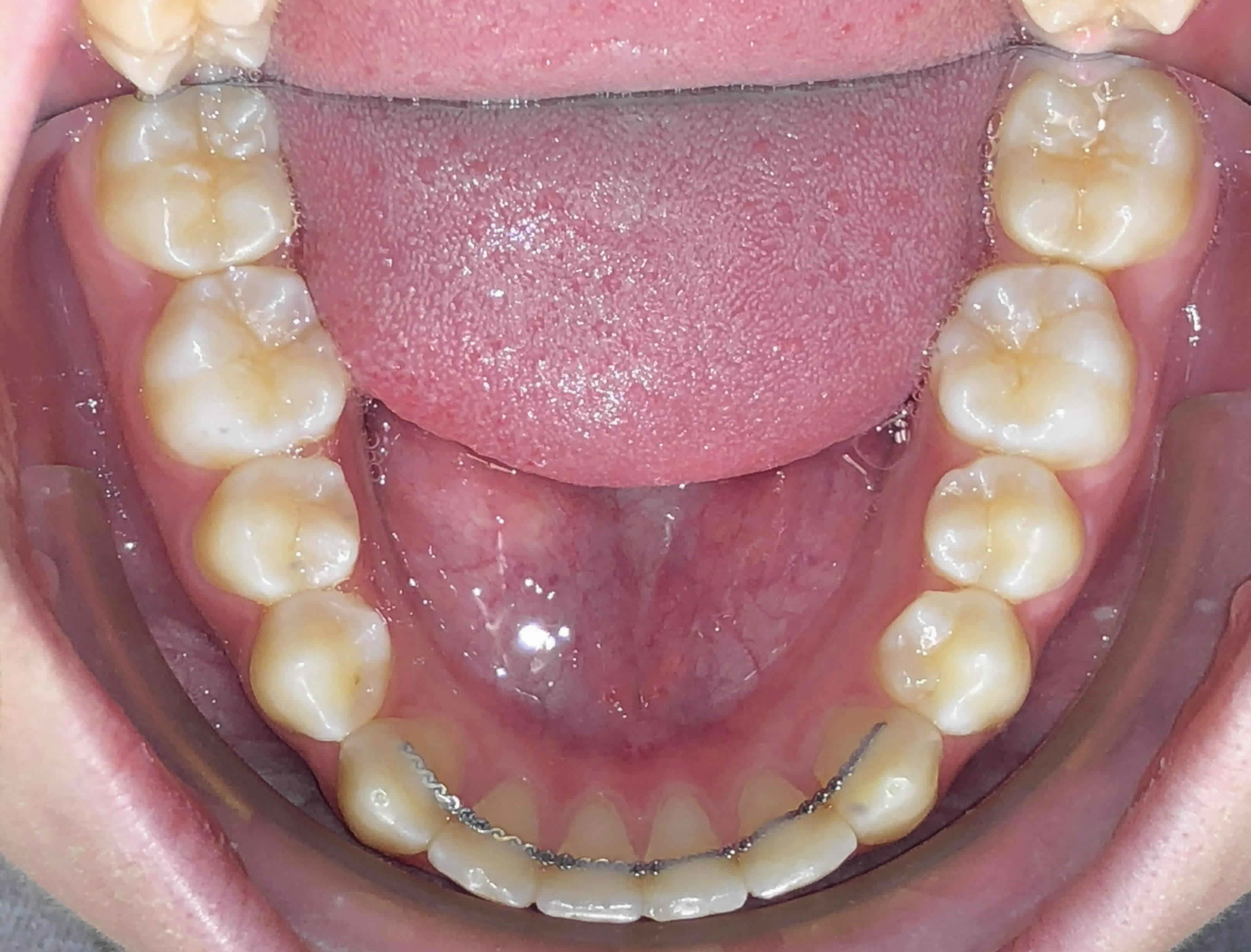 Appareils de contention pour enfant et adulte - Cabinet Challe & Co